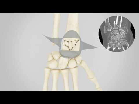 Prothelast - argomedical.com