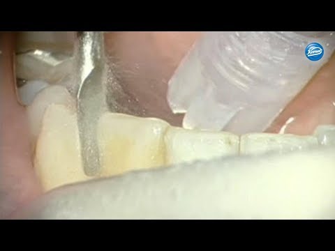 Video | IPR as part of an orthodontic treatment – Komet Dental